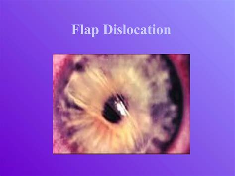 Refractive Surgery Basics Lasik Ppt