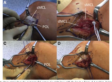 Structure Of Tendon Of Semimembranosus Semantic Scholar