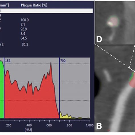 Pretest Probability Of Cad By Age Sex And Symptom Download Table