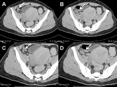 Ct Abdomen Demonstrates A Thickened And Enhanced Wall Vermiform Download Scientific Diagram