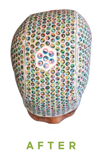 Head Shape Abnormalities Cranial Tedavi Merkezi