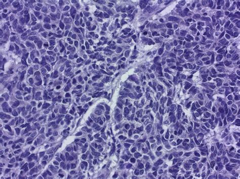 Absence Of Hla G Molecule Expression In Tumoral Tissue From Patients Download Scientific