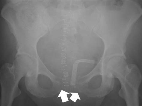 A Plain Radiograph Of The Anteriorposterior Pelvis Postoperatively