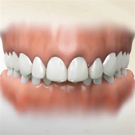 Deep Bite Invisalign