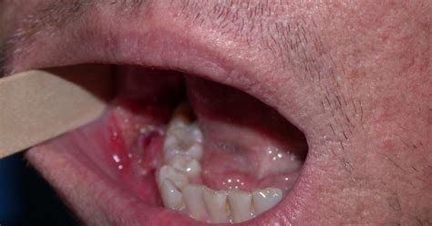 Mouth Cancer Pictures From Chewing Tobacco All Cancer