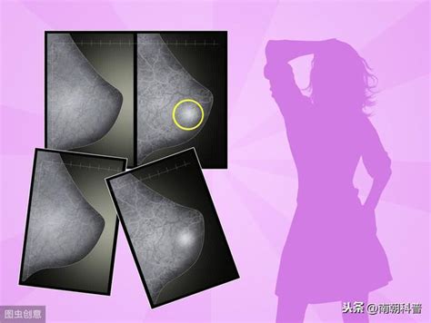 乳房結節大了、多了就是變壞了嗎？就是要癌變了嗎？ 每日頭條