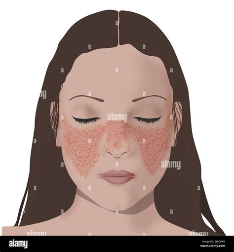 Rosacea Vs Lupus Butterfly Rash