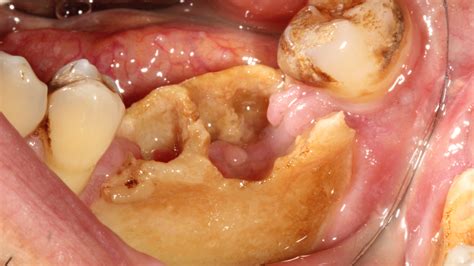 Risks Of Medication Related Osteonecrosis Of The Jaw In Cancer Patients