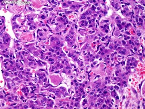 Pheochromocytoma Features Of Malignancy