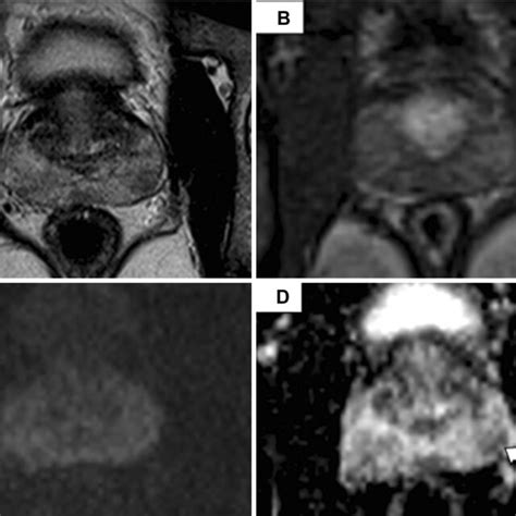 Example Pi Rads 3 Lesion In The Peripheral Zone 42 Year Old Patient