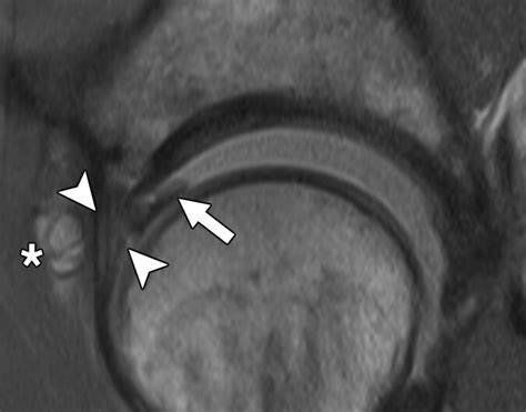 Best Practices Hip Femoroacetabular Impingement Ajr
