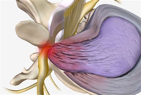 Preventing Herniated Discs Dos And Donts