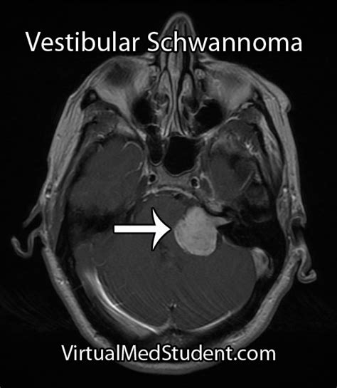 Acoustic Neuroma And Really We Mean Vestibular Schwannoma