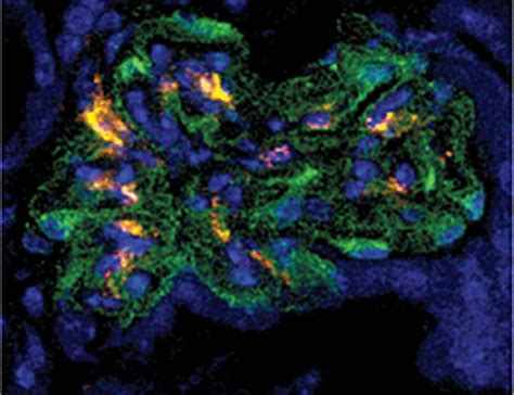 Sean Hart Phd On Linkedin Adeno Associated Virus Gene Therapy