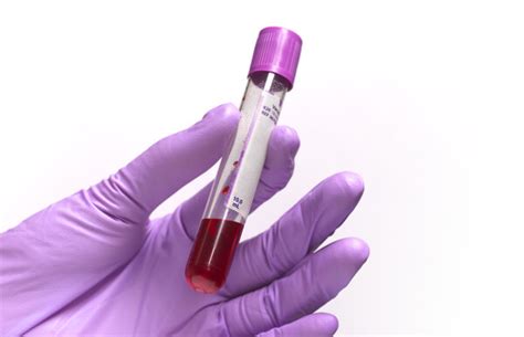 간암 조직생검 필요 없이 피 한방울로 예측