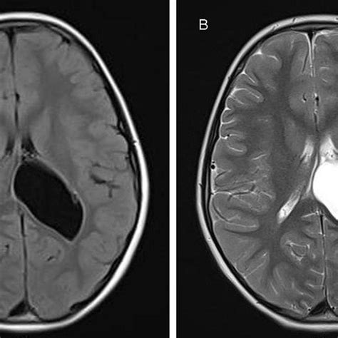 Diagnostic Algorithm Of Cpp In Girls Cpp Central Precocious Puberty