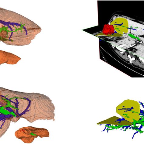 Preoperative Liver Rendering Liver Reconstruction With Layers Download Scientific Diagram