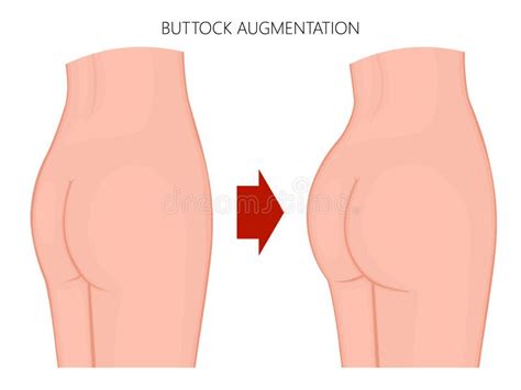 Human Body Problem Buttock Augmentation European Asian Woman Stock