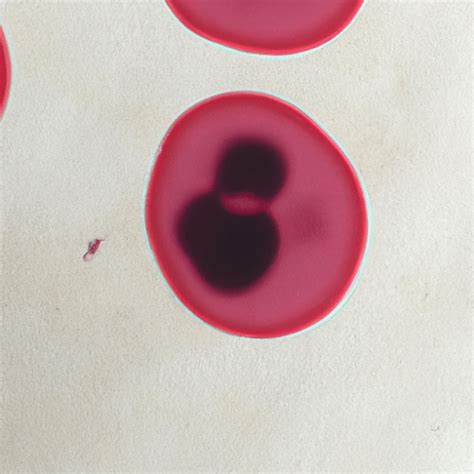 Difetti Congeniti Della Membrana Eritrocitaria Serendipity360