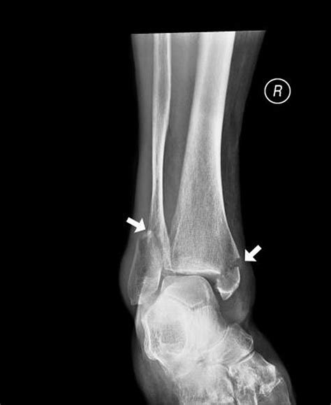 Generalidades Sobre Las Fracturas Lesiones Y Envenenamientos Manual