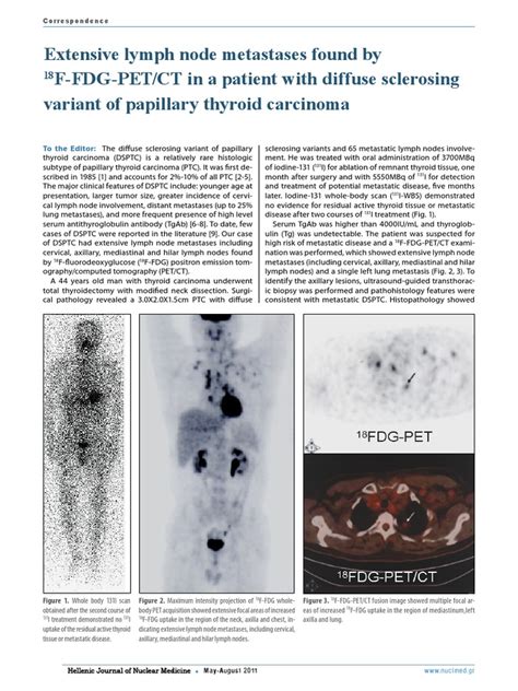 Diffuse Sclerosing Variant Of Papillary Thyroid Carcinoma Pdf