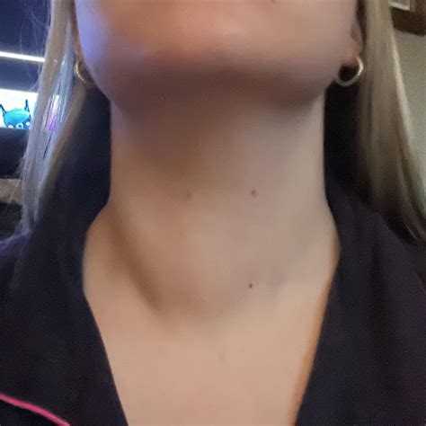 Thyroid Nodules And Goiter With All Clear Labsis There Any Way To Make