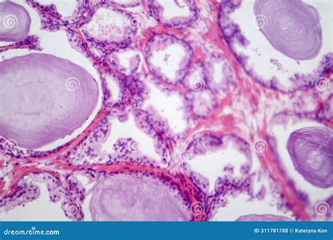Benign Prostatic Hyperplasia Light Micrograph Stock Photo Image Of Examination Symptoms