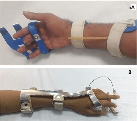 Dynamic Mobilization Splints Used In Patients With Flexor A And Download Scientific Diagram