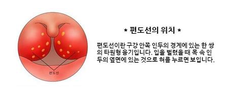 편도선염 음식 삼키기도 힘들어요