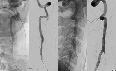 Vertebral Artery Dissection Anatomy