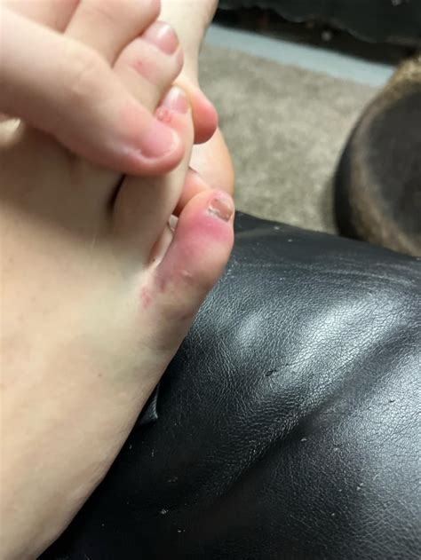 Did I Just Sprain Or Did I Break My Pink Toe R Diagnoseme