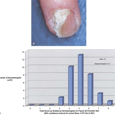 Pdf Nail Psoriasis Severity Index A Useful Tool For Evaluation Of Nail Psoriasis
