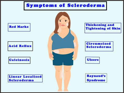 Stem Cell Therapy For Scleroderma In Mexico Medicaltourismco