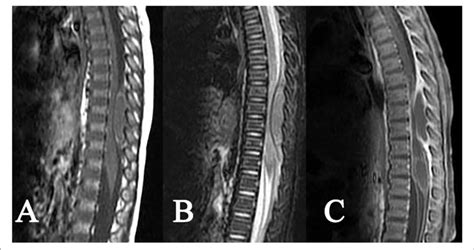 Epidural Tuberculoma Of The Thoracic Spinal Cord A Fusiform Lesion