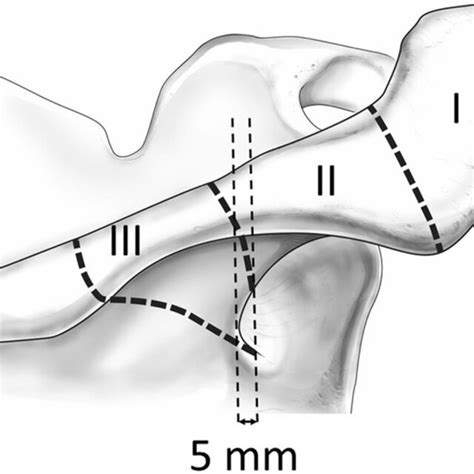 Developmental Process Of The Acromion At Birth The Ossified Spinous