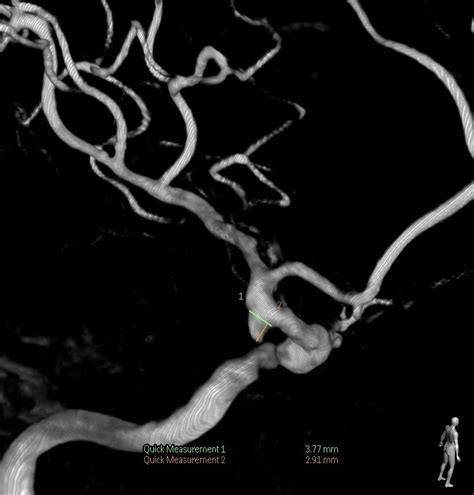 Ruptured Intracranial Aneurysm Image