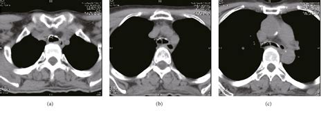 Bifurcation Of Trachea Semantic Scholar