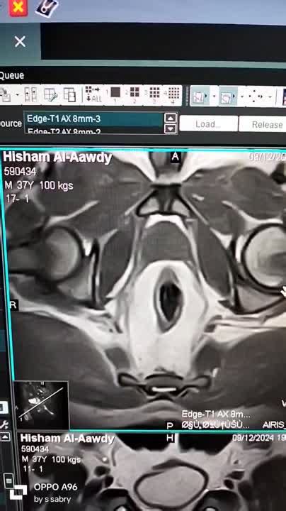 Elsayed Sabry On Linkedin Fistula Hetachi 03tesla