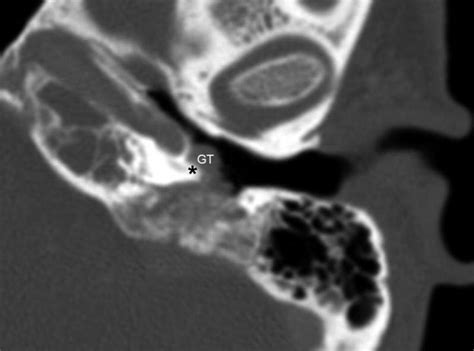 Pictures Of Glomus Tympanicum Otolaryngology Houston