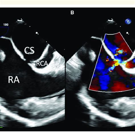 Transesophageal Echocardiogram Intraprocedural Transesophageal