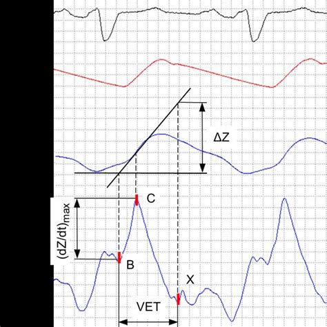 The Simultaneously Recorded Ecg Aortic Pressure P Aorta Reo