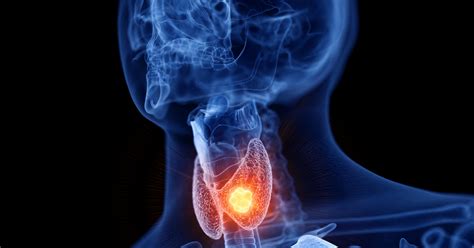 9 Things You Should Know About Thyroid Nodules Tryon Medical Partners