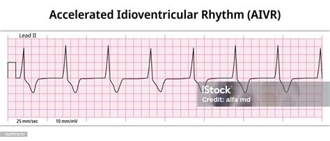 Ekg Accelerated Idioventricular Rhythm Kertas Ekg 8 Detik Ilustrasi