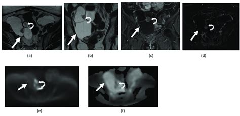 Axial A And Coronal B T2 Weighted Images And Contrast Enhanced