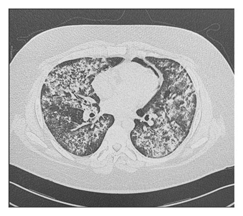 Pretreatment High Resolution Computed Tomography Download Scientific