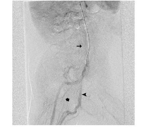 An Image From The Venous Phase Of The Angiogram Demonstrates The Ivc
