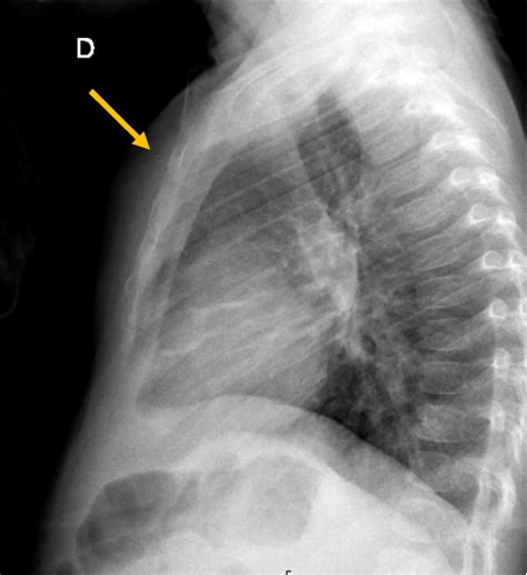 Selstoc A Sternal “do Not Touch” Lesion Eurorad