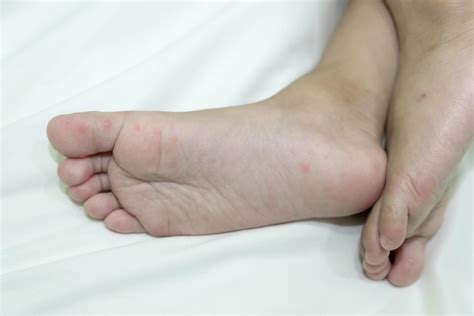 Empleador Monarquía Manía manchas rojas en las plantas de los pies