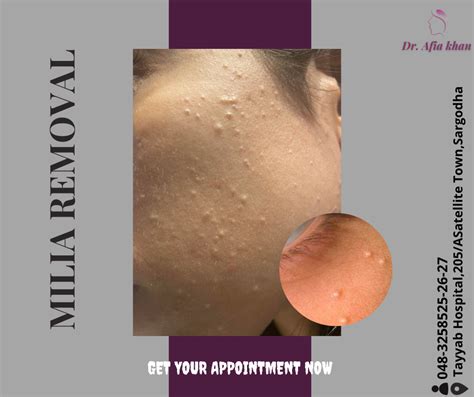 Dr Afia Khan A Milium Cyst Is A Small White Bump That