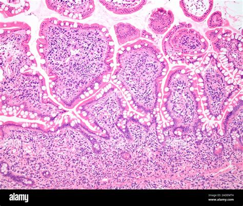 Light Micrograph Showing A Histiocytic Sarcoma Of The Small Bowel That